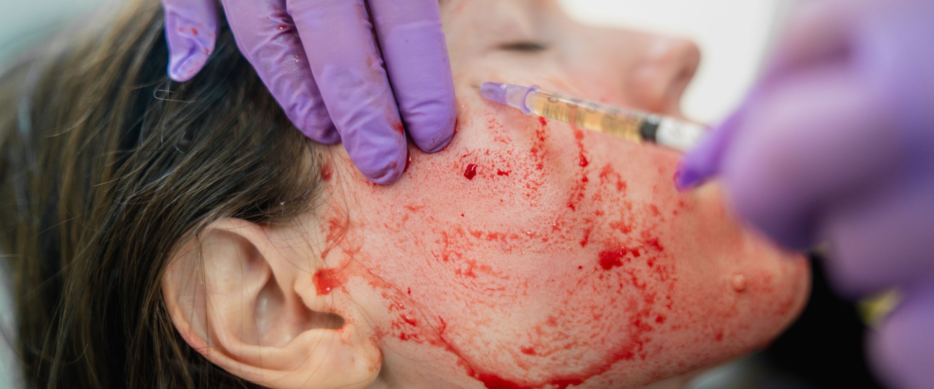 The Benefits of Vampire Facials: A Non-Invasive Way to Rejuvenate Your Skin