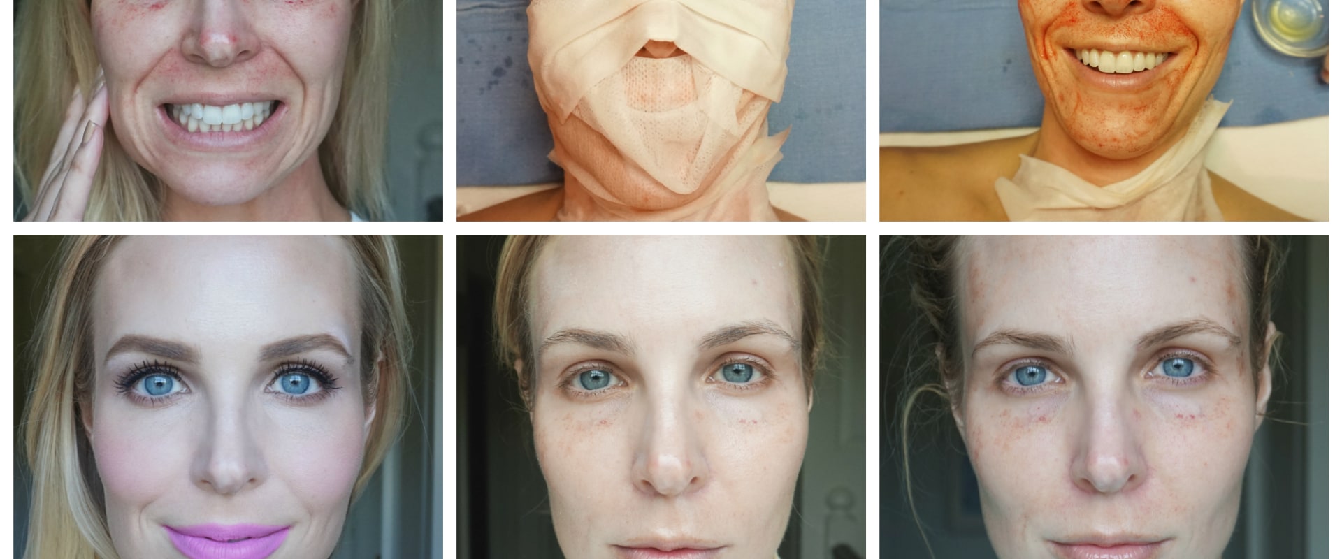 What is a Vampire Facial and How Can It Help Your Skin?