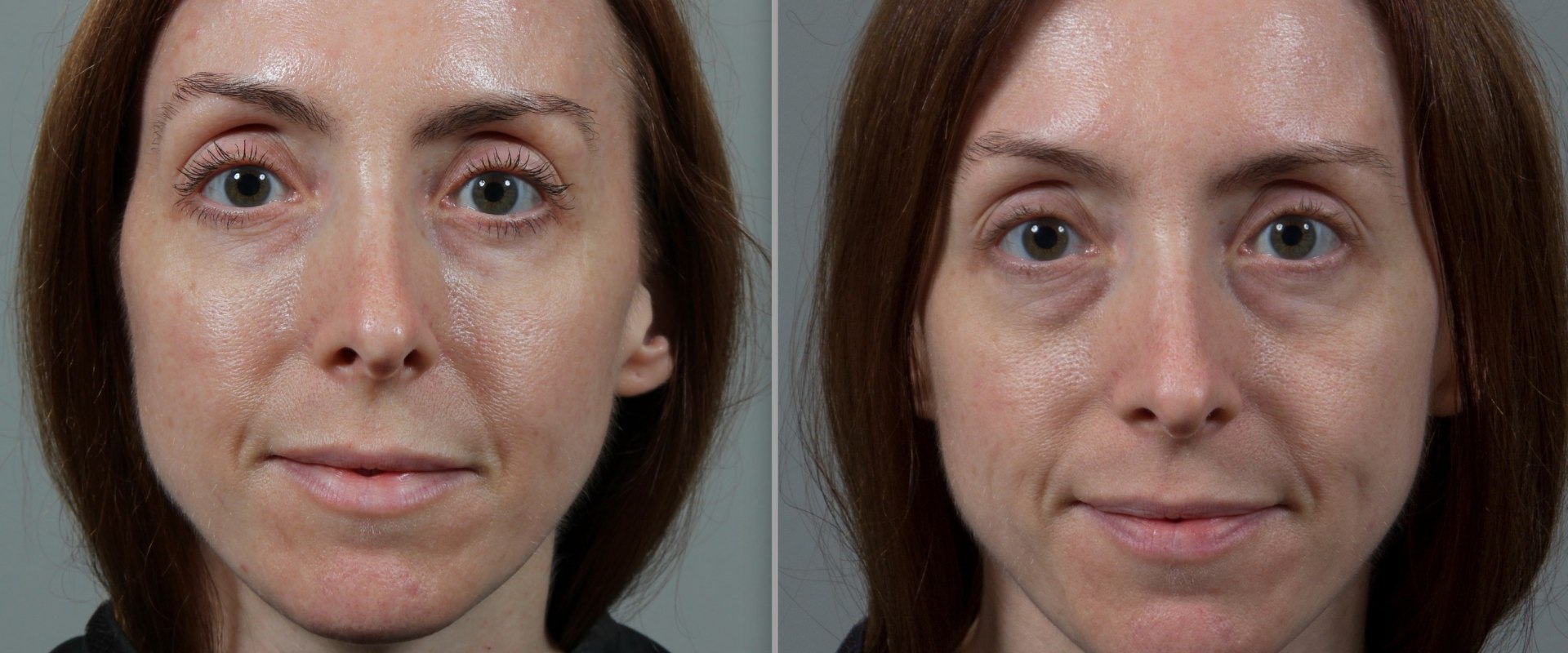 Is the vampire facial fda approved?